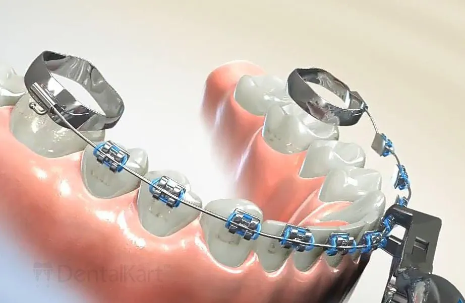 Buy Waldent Orthodontic Bracket Remover Offset Pliers | Best Bracket ...