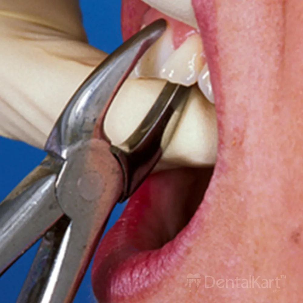 GDC Extraction Forceps Upper Anteriors - 1 Standard (FX1S) | Dentalkart