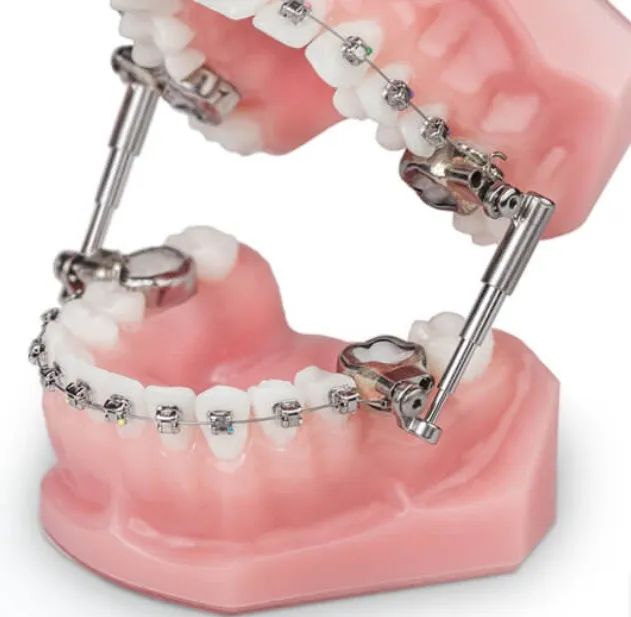 Ormco Advancsync 2 Class II Corrector | Dentalkart