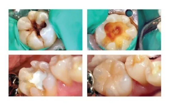 Maarc Ceraset MTA Putty