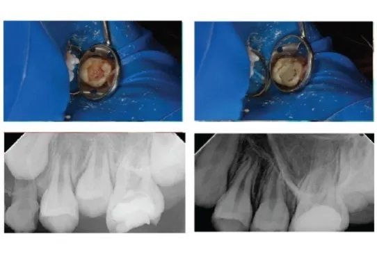 Maarc Ceraset MTA Putty