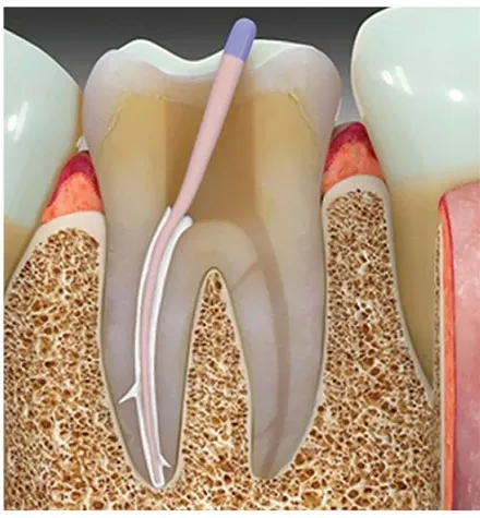 Get Maarc Rootfyx Online - High-Quality Bioceramic Root Canal Sealer ...