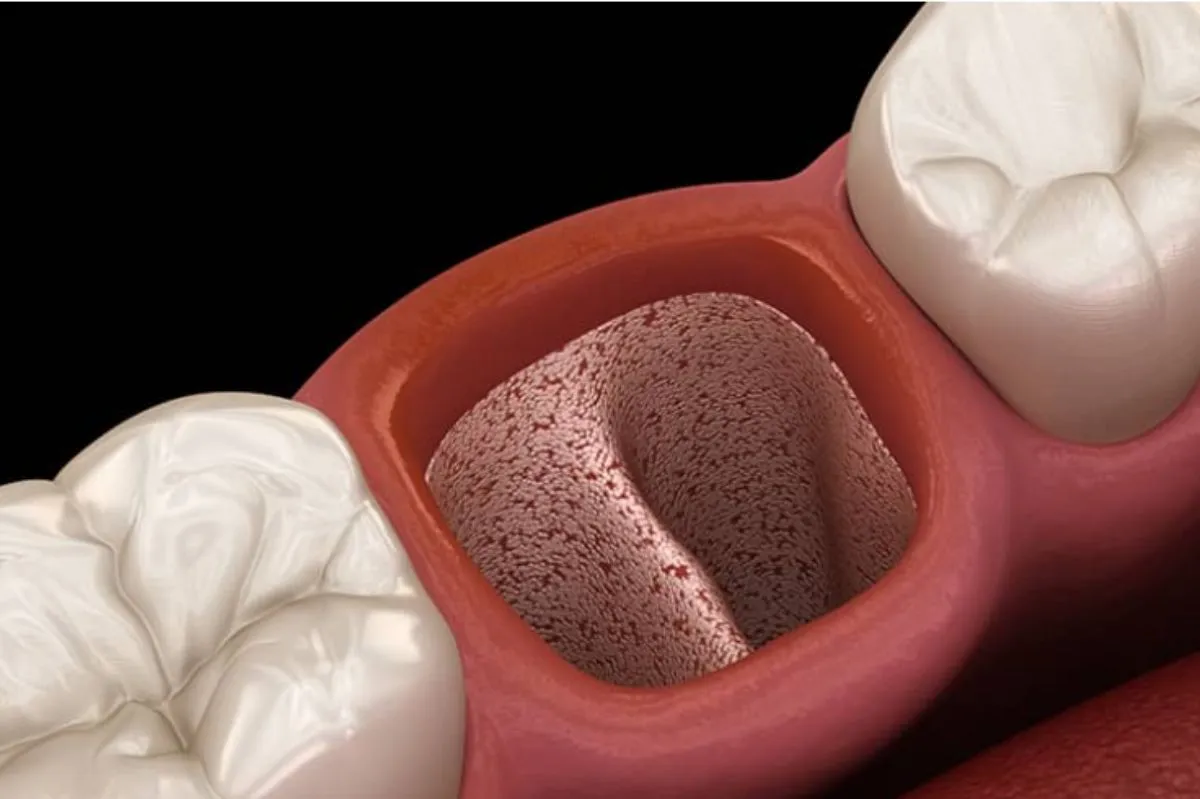 Vishal Dentocare A.O. Gel Dry Socket Paste 1