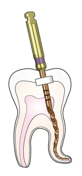 Woodpecker Rotary Files : Buy Endo Plus Heat Treated Gold Rotary File ...