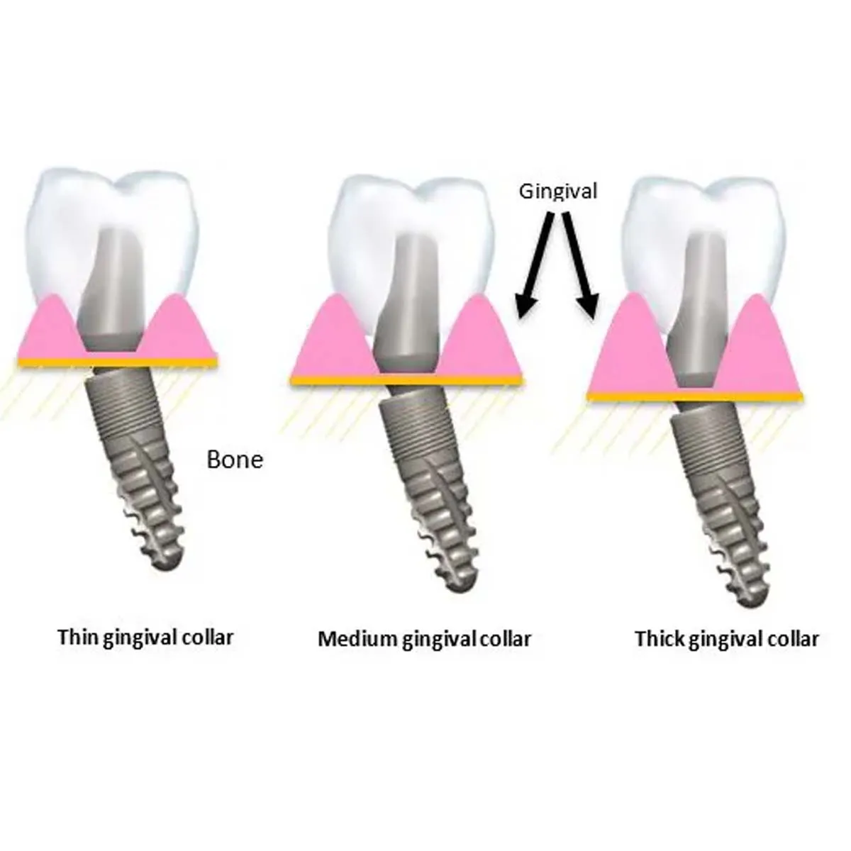 Xcem Dental Implant Angled Abutment Type B Mini 4.5mm - Hex