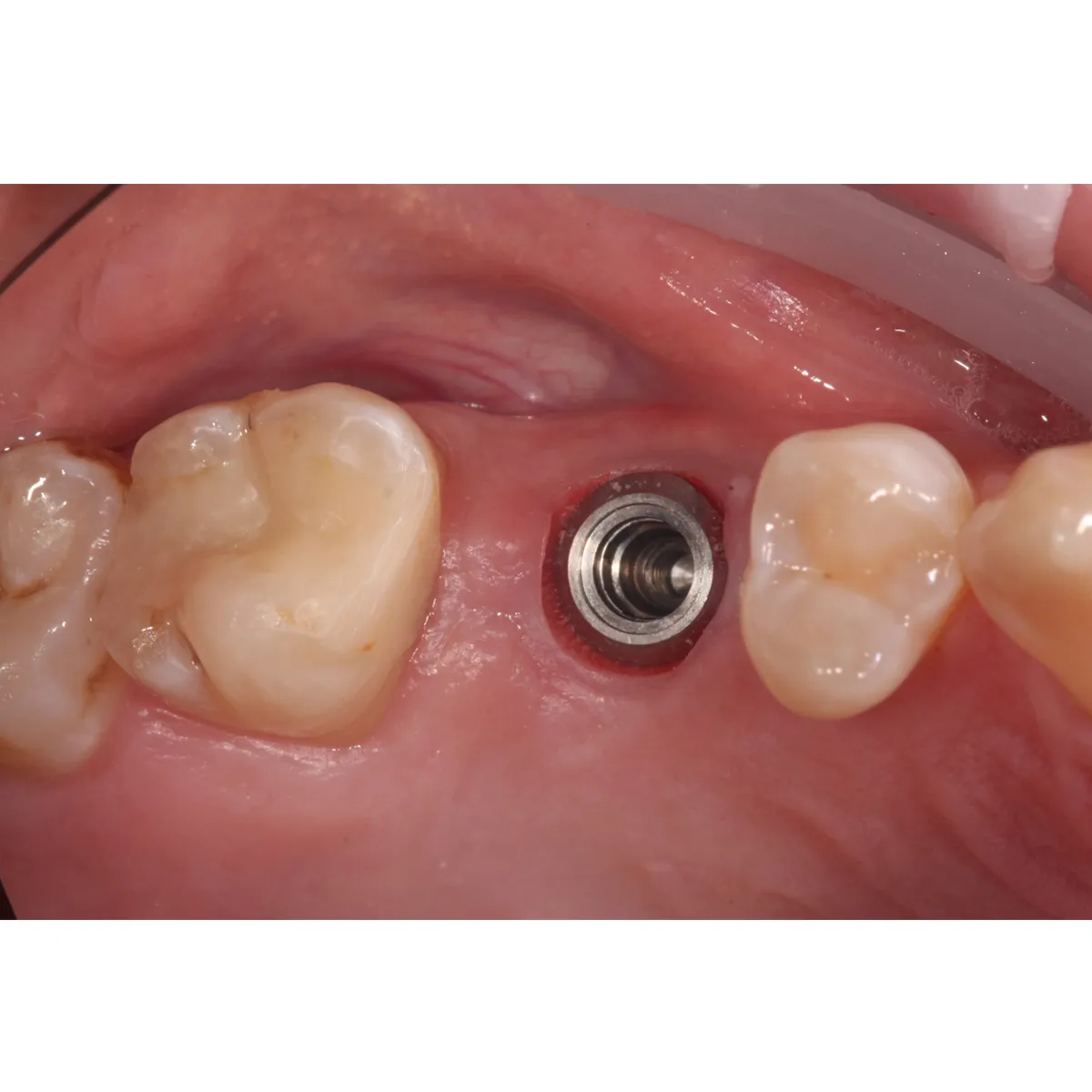 Xcem XVT Tissue Level Dental Implants